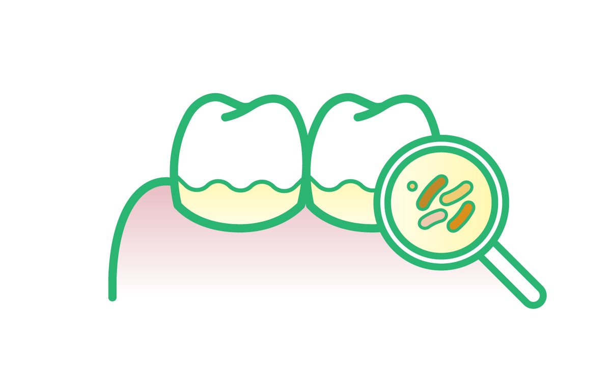 Dental Plaque Build Up | The Hidden Risks You May Not Know