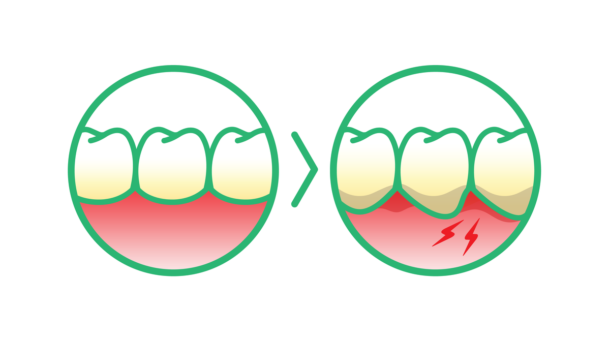 Gingivitis: Learn Why Gum Disease Prevention Matters