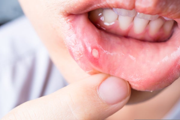Úlceras bucales: causas, tratamientos y métodos de prevención