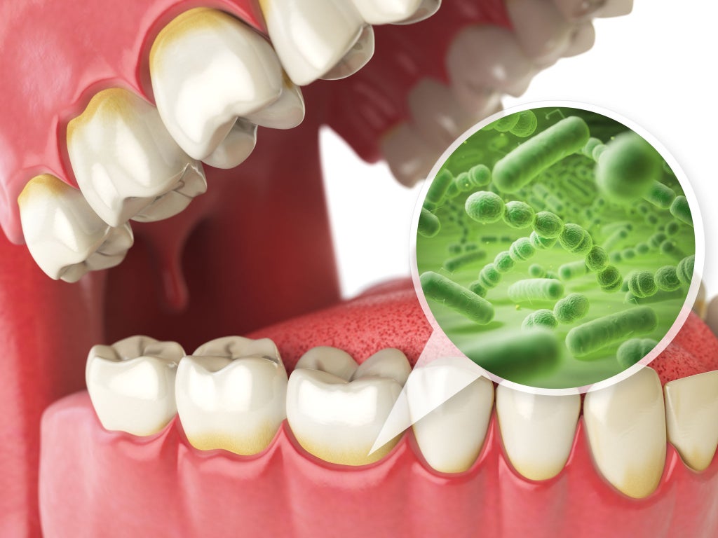 Deep Cleaning Teeth: What It Is & Why It Matters