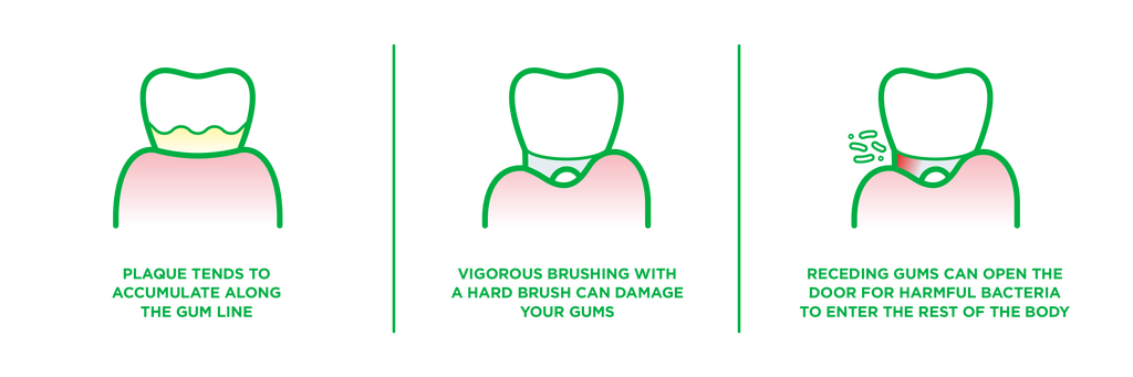 Receding Gums: A Guide to Detection and Treatment