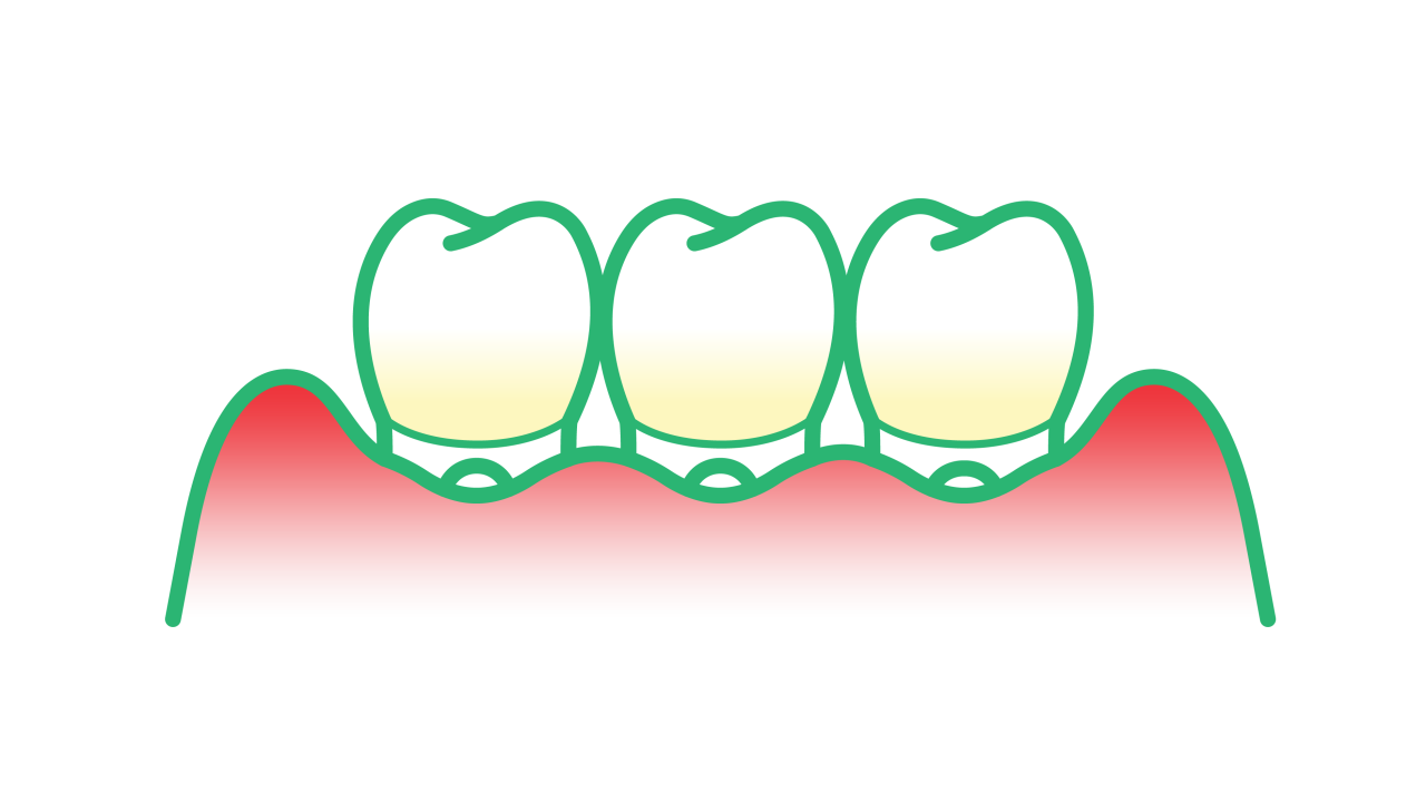 Het verschil tussen gevoelig tandvlees, gingivitis en parodontitis?