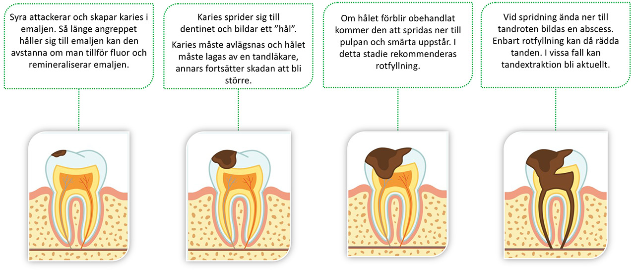 Karies – hål i tänderna